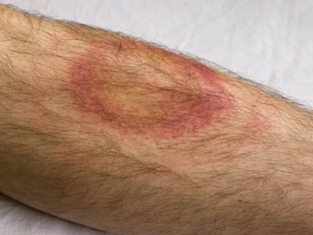 The bite stops here: Fighting Lyme disease with prevention - Penn State ...